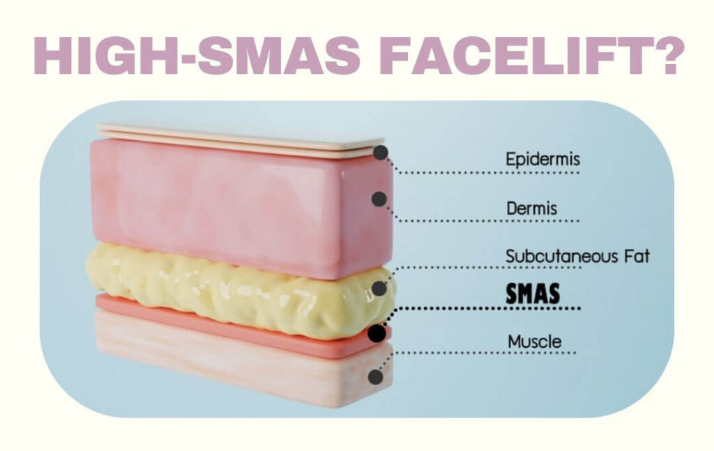Say Goodbye to Sagging Skin: How a High-SMAS Facelift Can Transform ...